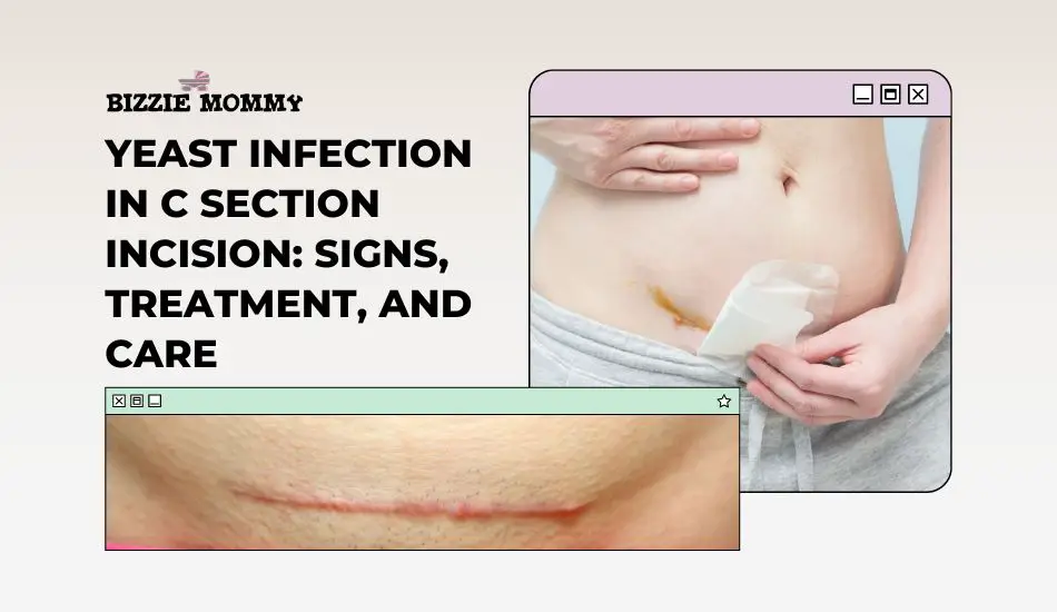 Yeast Infection in C Section Incision: Signs, Treatment, and Care - Bizzie Mom